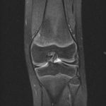 Le ménisque discoïde - ORTHOPEDIE-PEDIATRIQUE.COM