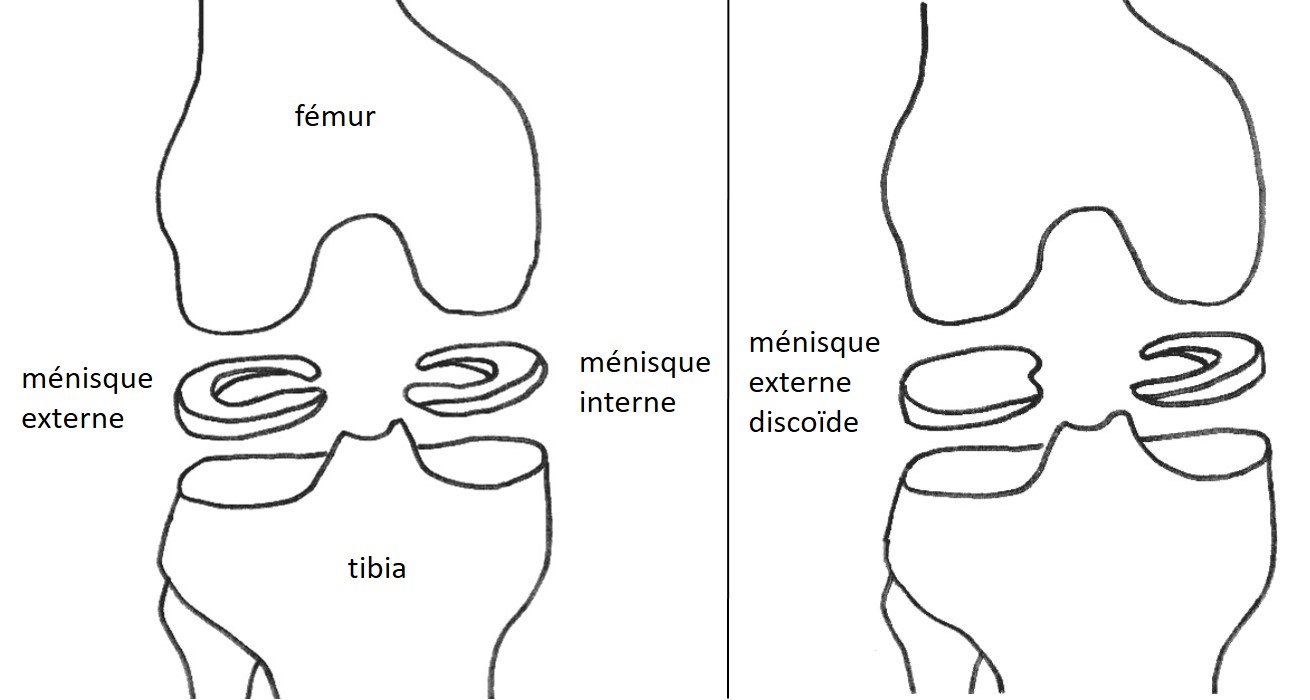 Le ménisque discoïde - ORTHOPEDIE-PEDIATRIQUE.COM
