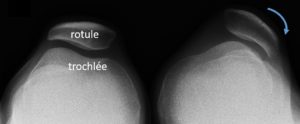 La luxation et l'instabilité de rotule - ORTHOPEDIE-PEDIATRIQUE.COM