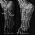 Les synostoses - ORTHOPEDIE-PEDIATRIQUE.COM