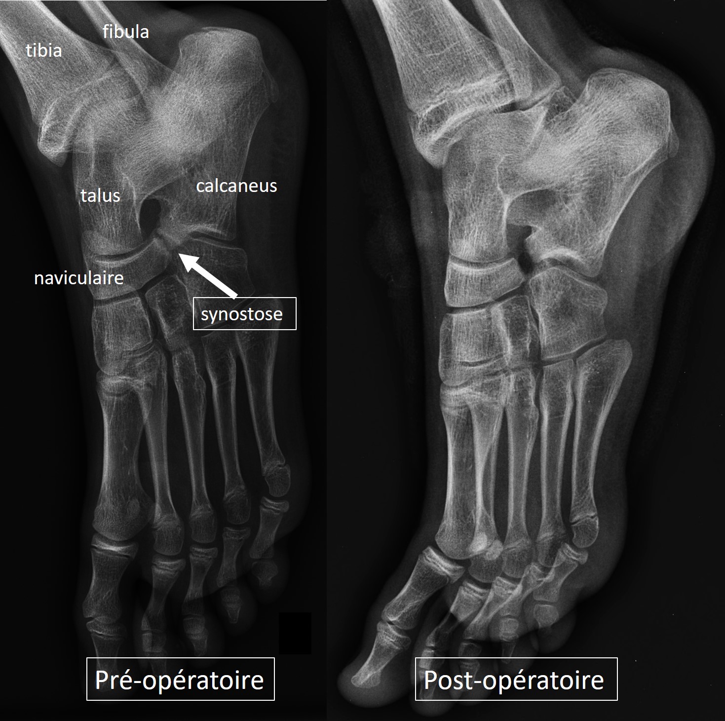 Les synostoses - ORTHOPEDIE-PEDIATRIQUE.COM