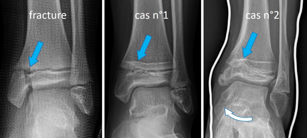 Fractures passant par un cartilage de croissance Fractures passant par un cartilage de croissance