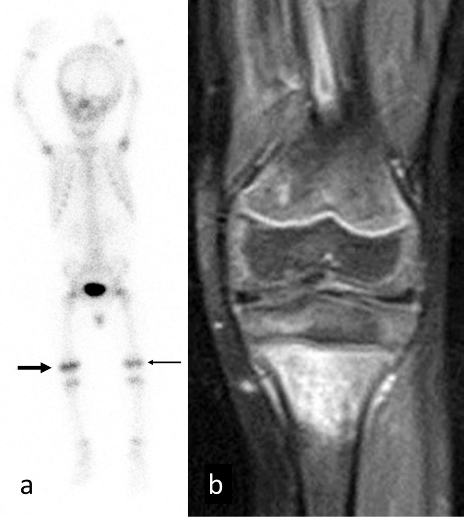 Les arthrites et les ostéomyélites - ORTHOPEDIE-PEDIATRIQUE.COM