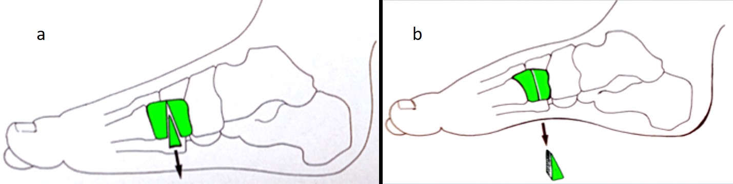 La chirurgie de correction du pied plat chez l'enfant - ORTHOPEDIE ...