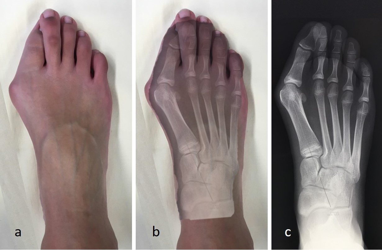 L'hallux valgus de l'enfant - ORTHOPEDIE-PEDIATRIQUE.COM