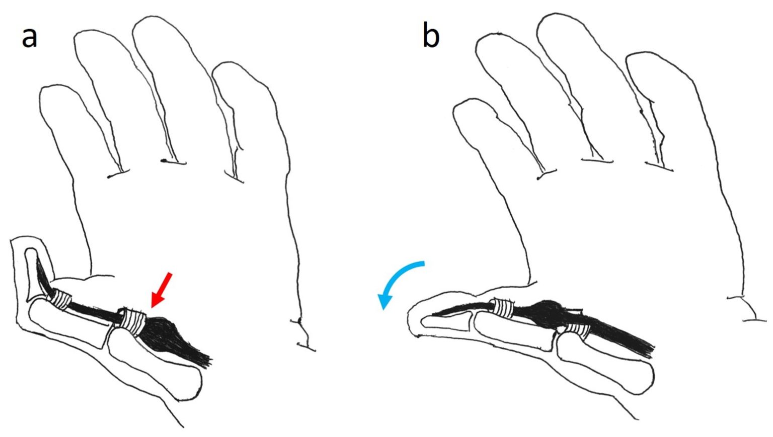 Le pouce à ressaut chez l'enfant - ORTHOPEDIE-PEDIATRIQUE.COM