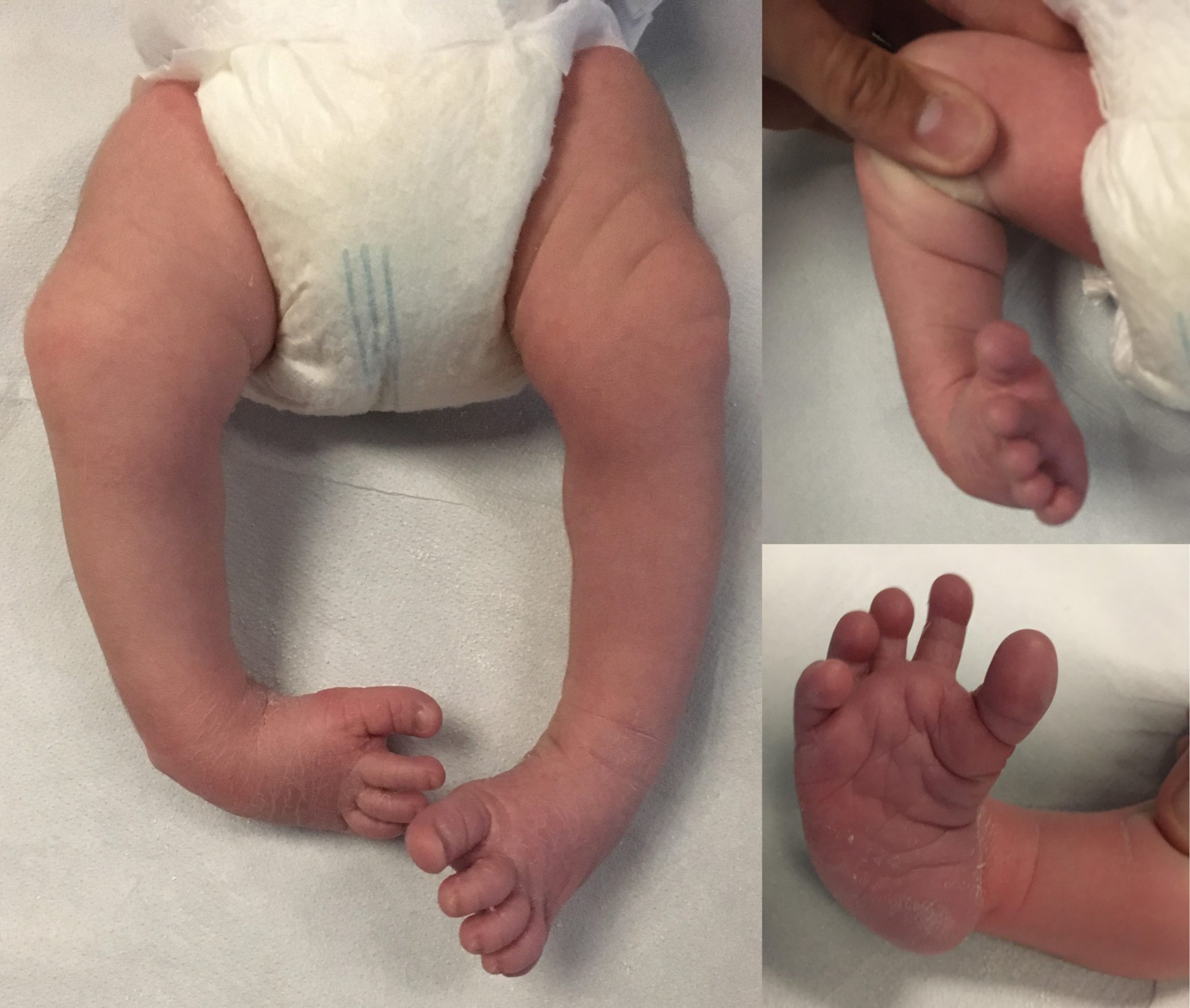 Le pied bot - ORTHOPEDIE-PEDIATRIQUE.COM